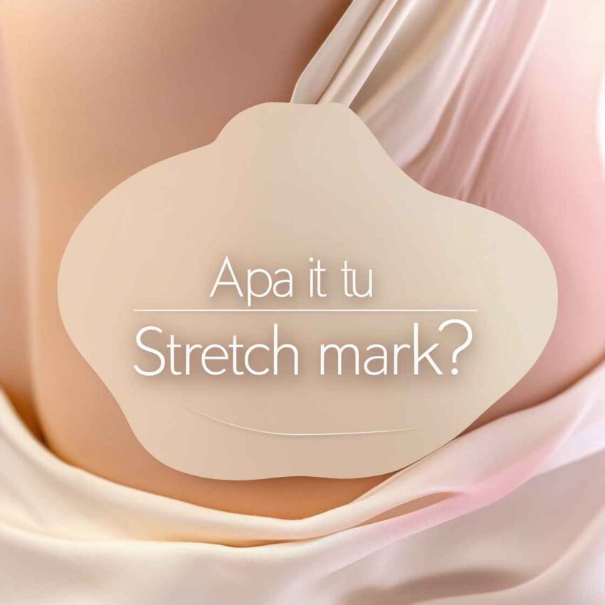 Stretch Mark: 8 Rahasia Mengejutkan yang Bikin Lo Pede Meski Ada ...