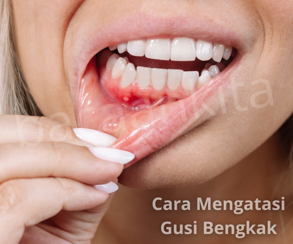 5 Cara Gampang & Ampuh Buat mengatasi Gusi Bengkak Secara Alami, Biar ...